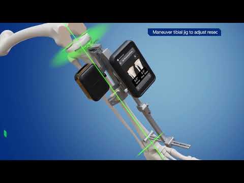 OrthAlign Lantern® バランス - 動画要約 - Glarity