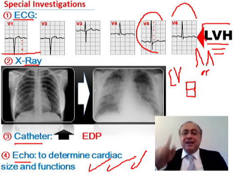 Herzinsuffizienz: EKG Diagnostik und USMLE Vorbereitung ...